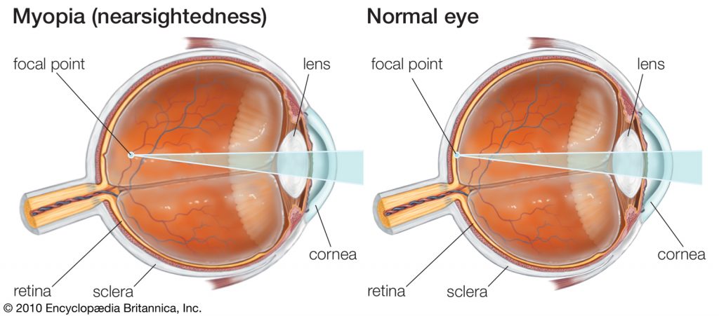 Nearsighted Vision What Are The 2 Main Causes Of Myopia Eyeviser Nearsighted Vision What Are The 2 Main Causes Of Myopia Eyeviser